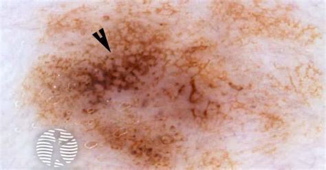 Dermoscopy Image