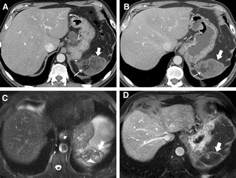 A 72 Year Old Man Post Distal Pancreatectomy And Splenectomy For Download Scientific Diagram