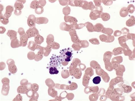 Pseudothrombocytopenia 2
