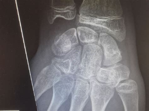 Wristarthroscopy Pediatric Scaphoid Fracture