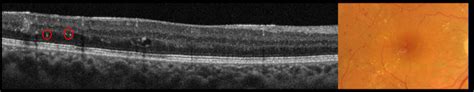 Dots Spots And Other White Retinal Lesions Page 14 Of 61 Retina