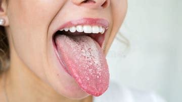 Tongue With White Coating Oral Thrush Or Candidiasis Stock