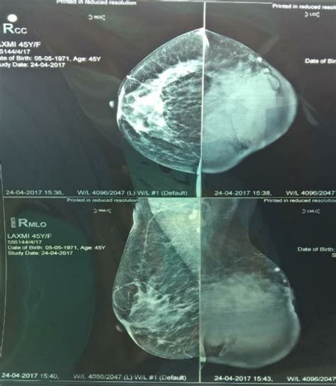 Diagnosis Of Benign Phyllodes Tumor Download Scientific Diagram