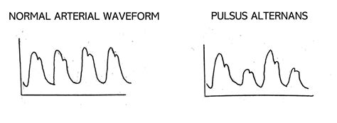 Pulsus Paradoxus Vs Pulsus Alternans Klarity Health Library