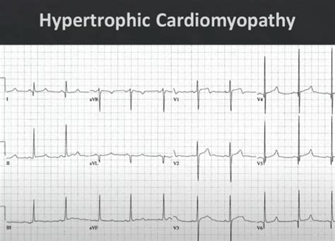 611 Another Example Of Ecg Of Hypertrophic Cardiomyopathy