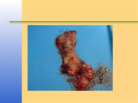 Stapler Hemorrhoidectomy 3 Ppt