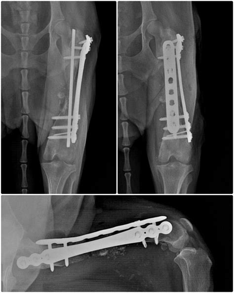 Moataz Galal On Linkedin Op Orthogonal Plating Double Plating