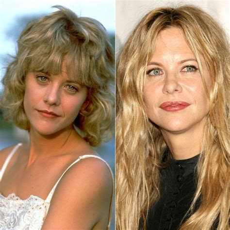 Meg Ryan Plastic Surgery Before After