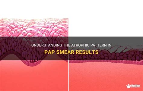 Understanding The Atrophic Pattern In Pap Smear Results Medshun