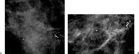 Calcifications Fine Linear Branching Microcalcifications Radiology Key
