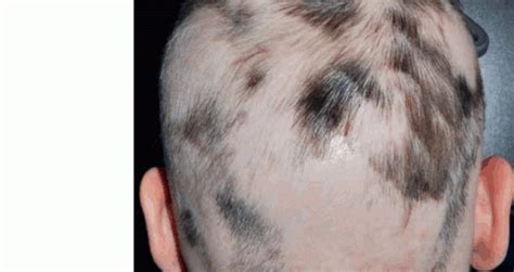 Diseases Of The Scalp Alopecia Areata Androgenic Hirsutism Healthy