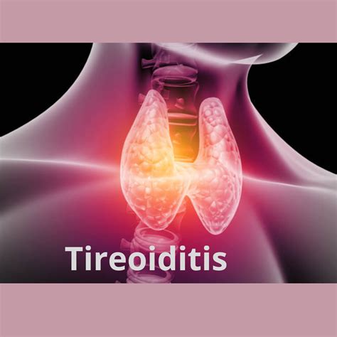 Tireoiditis Mi Encuentro Conmigo