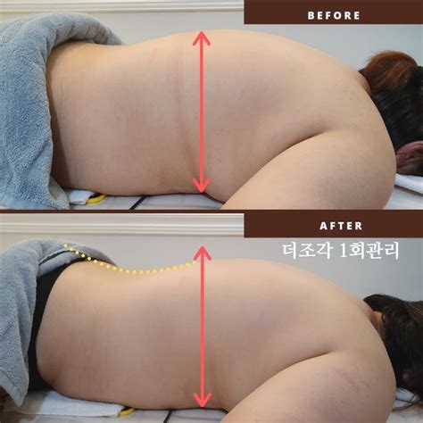 더조각테라피 대구등관리 살이 찌는 이유는 따로 있다 네이버 블로그