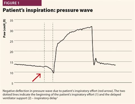 Waveform Based Management Of Patientventilator Synchronisation