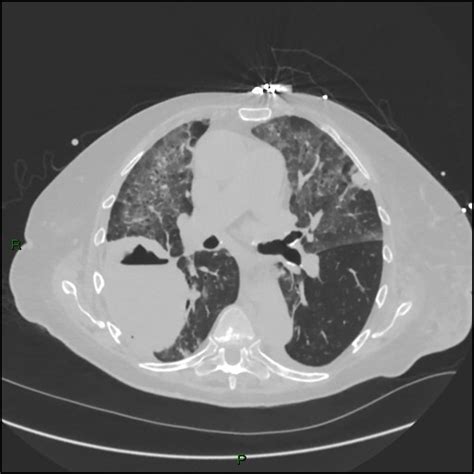 Filelung Abscess Its Drainage And Resolution Radiopaedia 82375