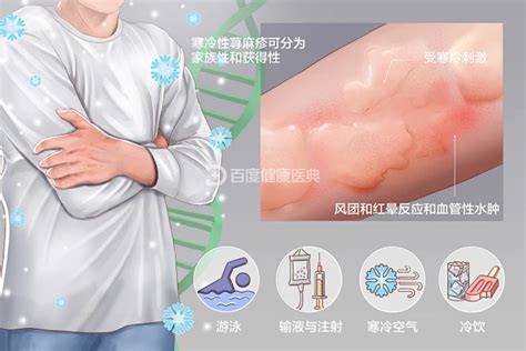 寒冷性荨麻疹 花瓣网