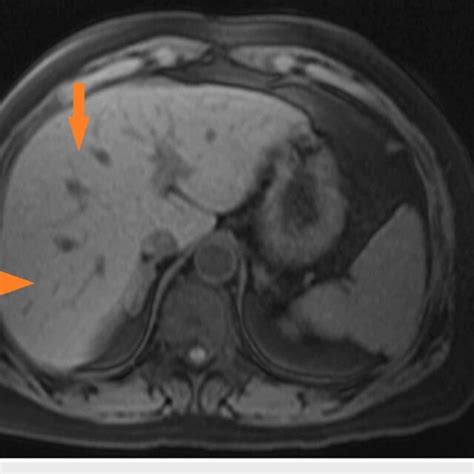 Mrcp Sagittal And Axial Planes Revealing Cholelithiasis Blue Arrows