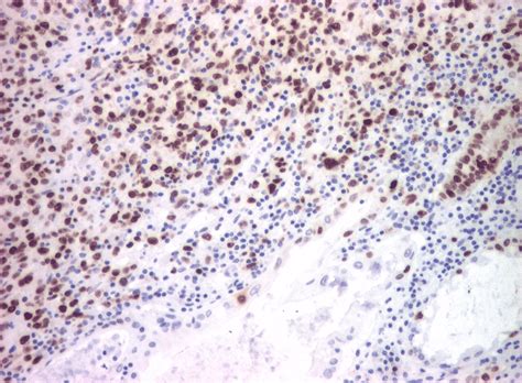 Positive Ki 67 Immunostaining In Over 50 Of Tumor Cells Anti Ki 67