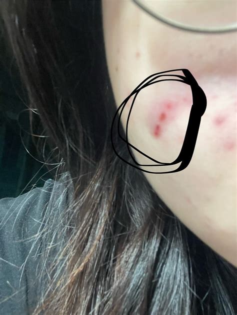 아프고 딱딱한 속 여드름 지식in