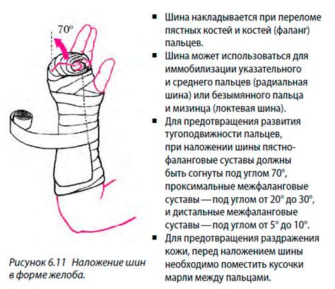 Как вправить мизинец на руке: Как вправить вывихнутый палец ...