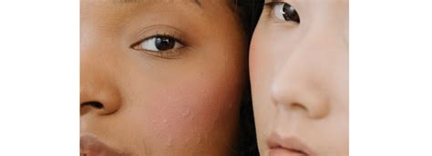 Descubre Los Diferentes Tipos De Manchas En La Piel Y Cómo Abordarlas