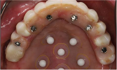 First Digital Scan Of Conversion Prosthesis With Fiducial Markers