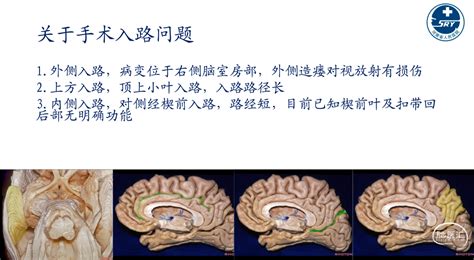 【病例分享】陈航主任医师团队：对侧经楔前叶入路处理脑室房部病变的思考 脑医汇