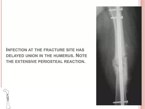 Osteomyelitis Pptx