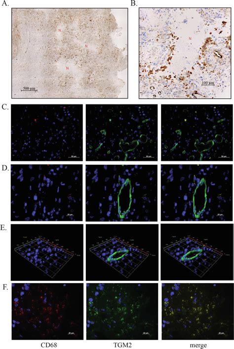 Transglutaminase 2 Function In Glioblastoma Tumor Efferocytosis Pmc