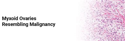 Myxoid Ovaries Resembling Malignancy