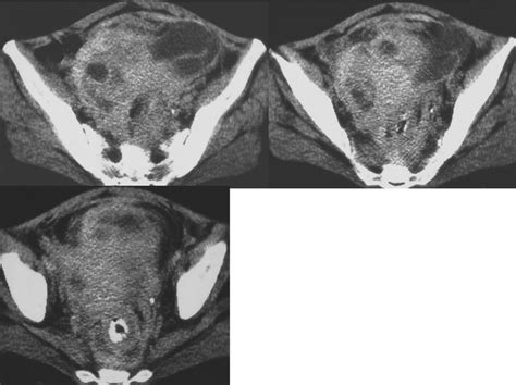 30 Years Old Woman With Actinomycosis Picd Contrast Enhanced Pelvic Download Scientific