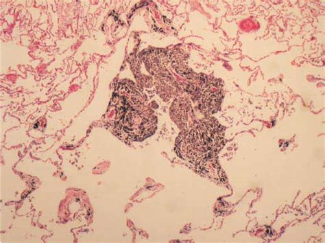 Respiratory Bronchiolitis Hrct Shows Diffuse Poorly Circumscribed Download Scientific Diagram
