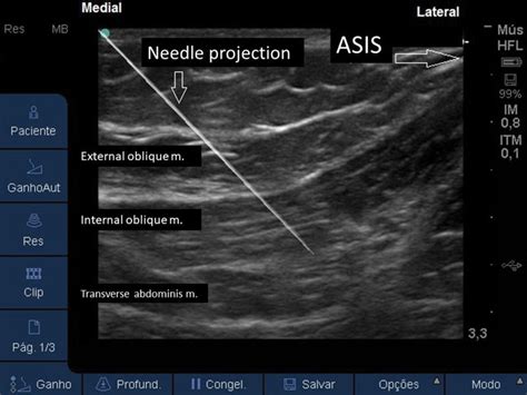 Ilioinguinal Nerve Block Ultrasound