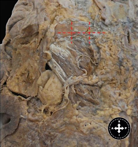 Scielo Brasil Topographic Anatomy Of The Masseteric Nerve Applied To