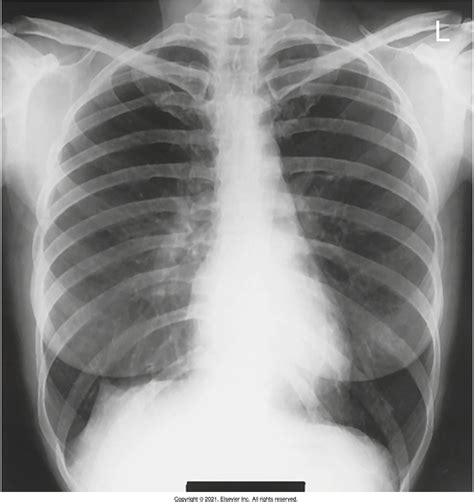 Chest Anatomy Diagram Quizlet