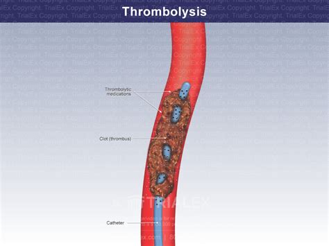 Thrombolysis Trialquest Inc