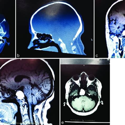 A Computed Tomography Ct Head Axial View B Ct Head Sagittal