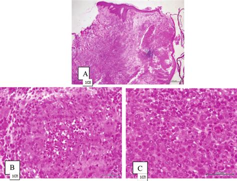 Anterior Thorax Punch Biopsy A A Skin Biopsy Of One Of The Cutaneous
