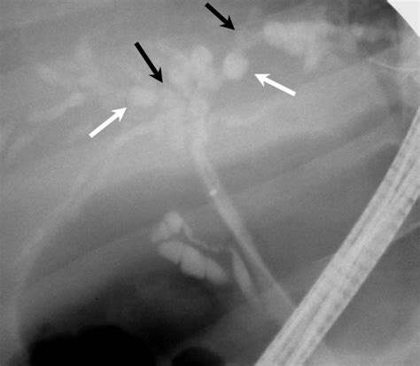 Primary Sclerosing Cholangitis — Medlibes Online Medical Library