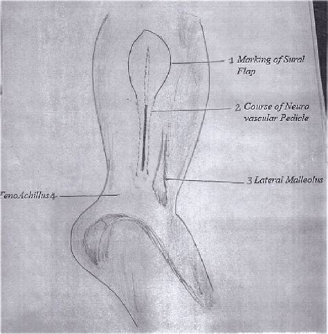 Figure D Steps Of Flap Dissection Download Scientific Diagram