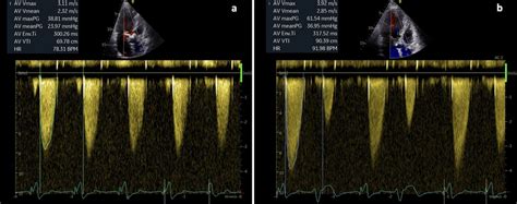 Aortic Cw Doppler Flow Pattern In A Patient With Moderate Aortic