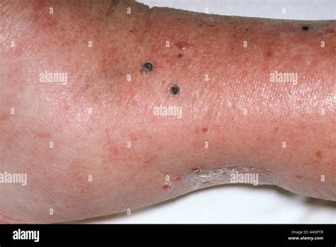Le Mélanome Malin Est Une Forme Grave De Cancer De La Peau Banque Dimages Photo Stock 6312202