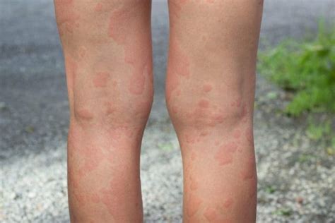 最も人気のある！ Break Into Hives Every Night 335034 Why Do I Randomly Break