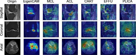 A Novel Deep Learning Model For Diagnosing Knee Abnormalities Like An Experienced Radiologist