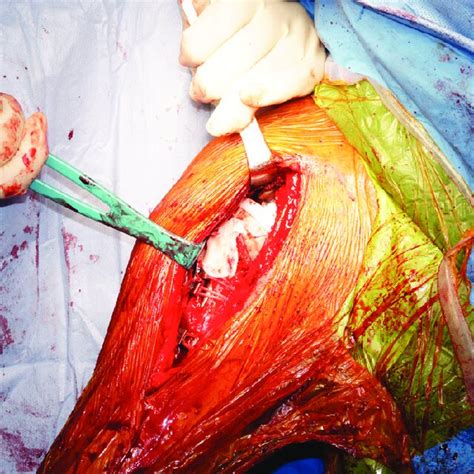 A 2 Years Follow Up X Ray For An Outpatient Reverse Total Shoulder Download Scientific Diagram