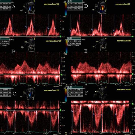 Continuous Wave Doppler Across Tricuspid Valve Obtained During Paced