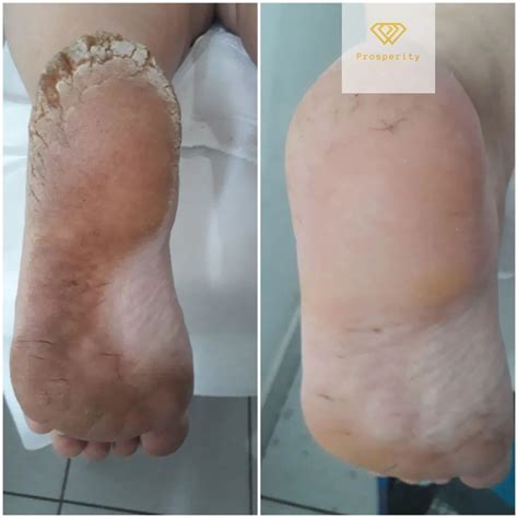Plástica Dos Pés Hidracalo Spa De Pés 300ml 222 creme Ureia