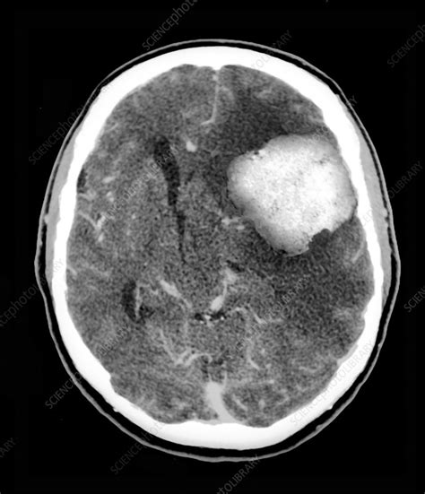 Benign Brain Tumour Ct Scan Stock Image C0267914 Science Photo