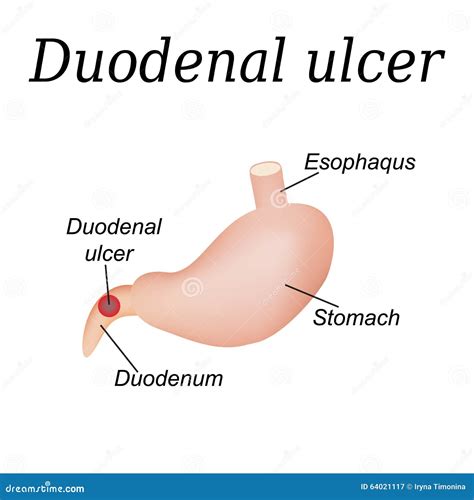 Duodenum Ulcer Affected Duodenal Ulcer Vector Illustration On A