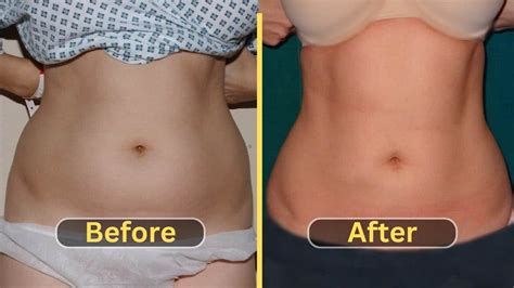 Lipo 360 Before And After Transformations Get A Dream Body With